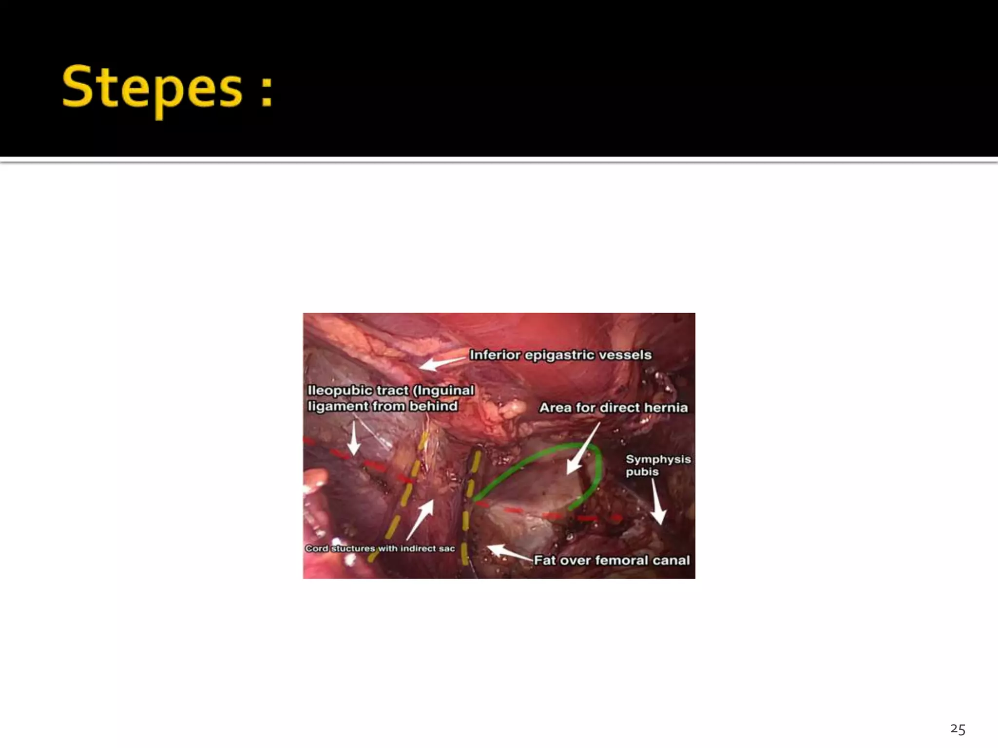 Anatomy & technique of the laparoscopic totally extra peritoneal | PPTX
