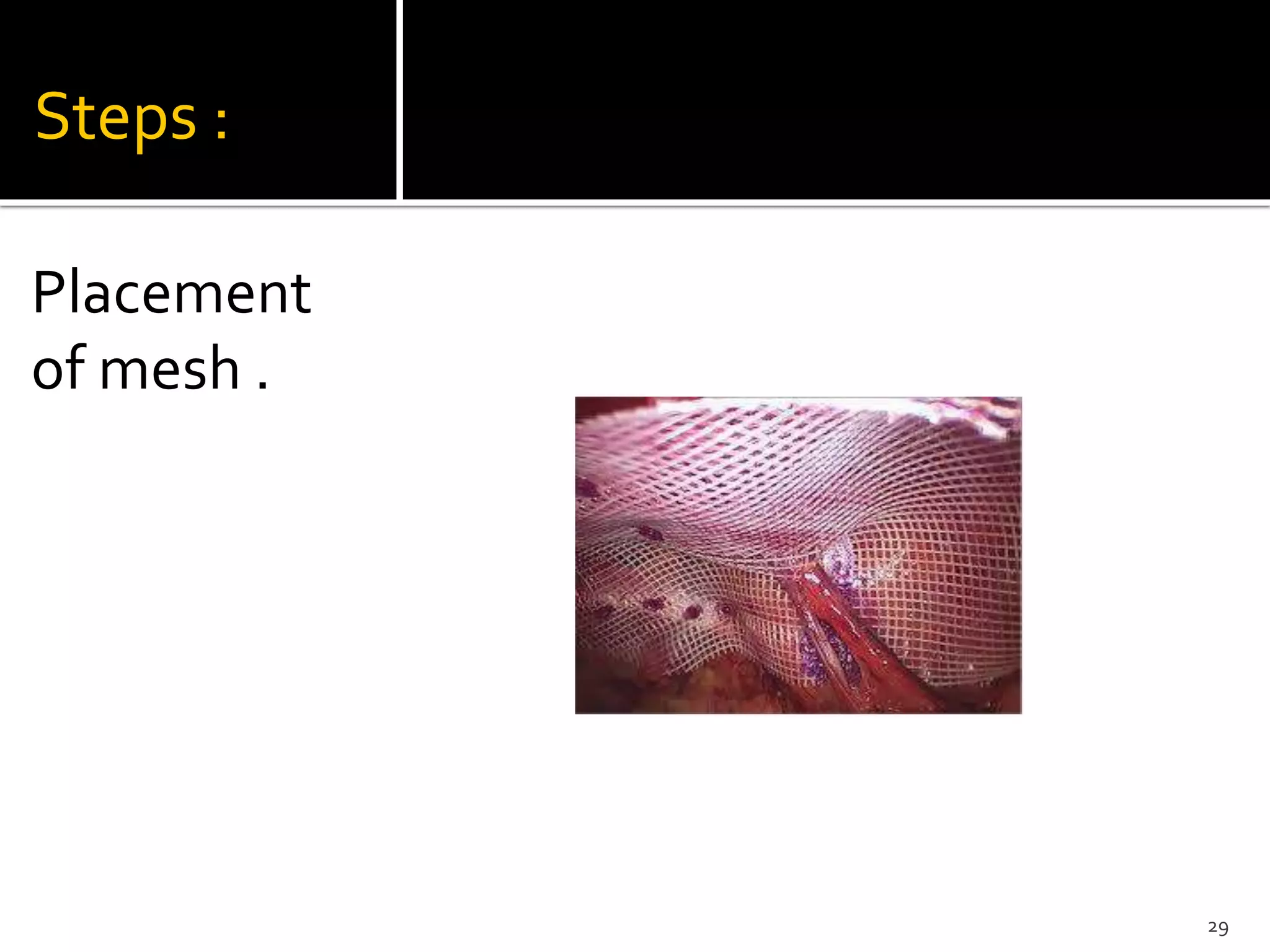 Anatomy & technique of the laparoscopic totally extra peritoneal | PPTX