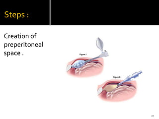 Anatomy & technique of the laparoscopic totally extra peritoneal | PPTX