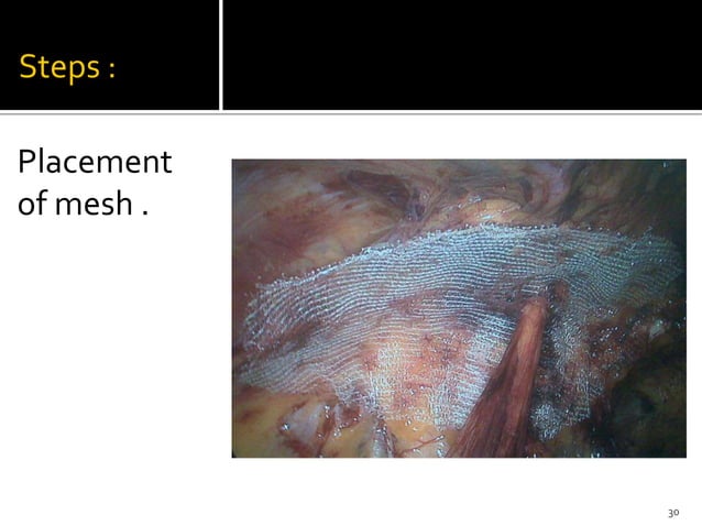 Anatomy & technique of the laparoscopic totally extra peritoneal | PPTX