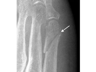 Anatomy unit 5 skeletal and muscular systems bone injury and repair ...