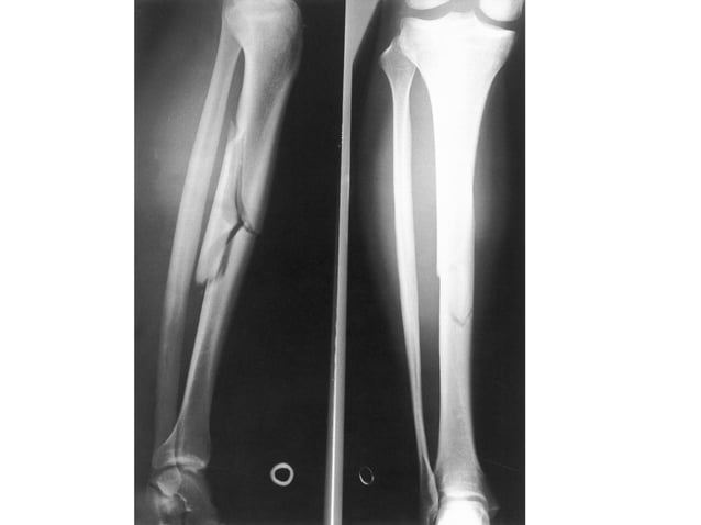 Anatomy unit 5 skeletal and muscular systems bone injury and repair ...