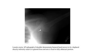 Anatomy and xrays of shoulder joint | PPTX
