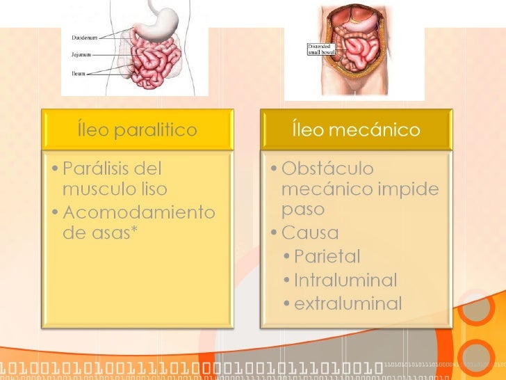 Anatoooo obstrucción intestinal