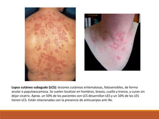LUPUS ERITEMATOSO SISTEMICO | PPTX