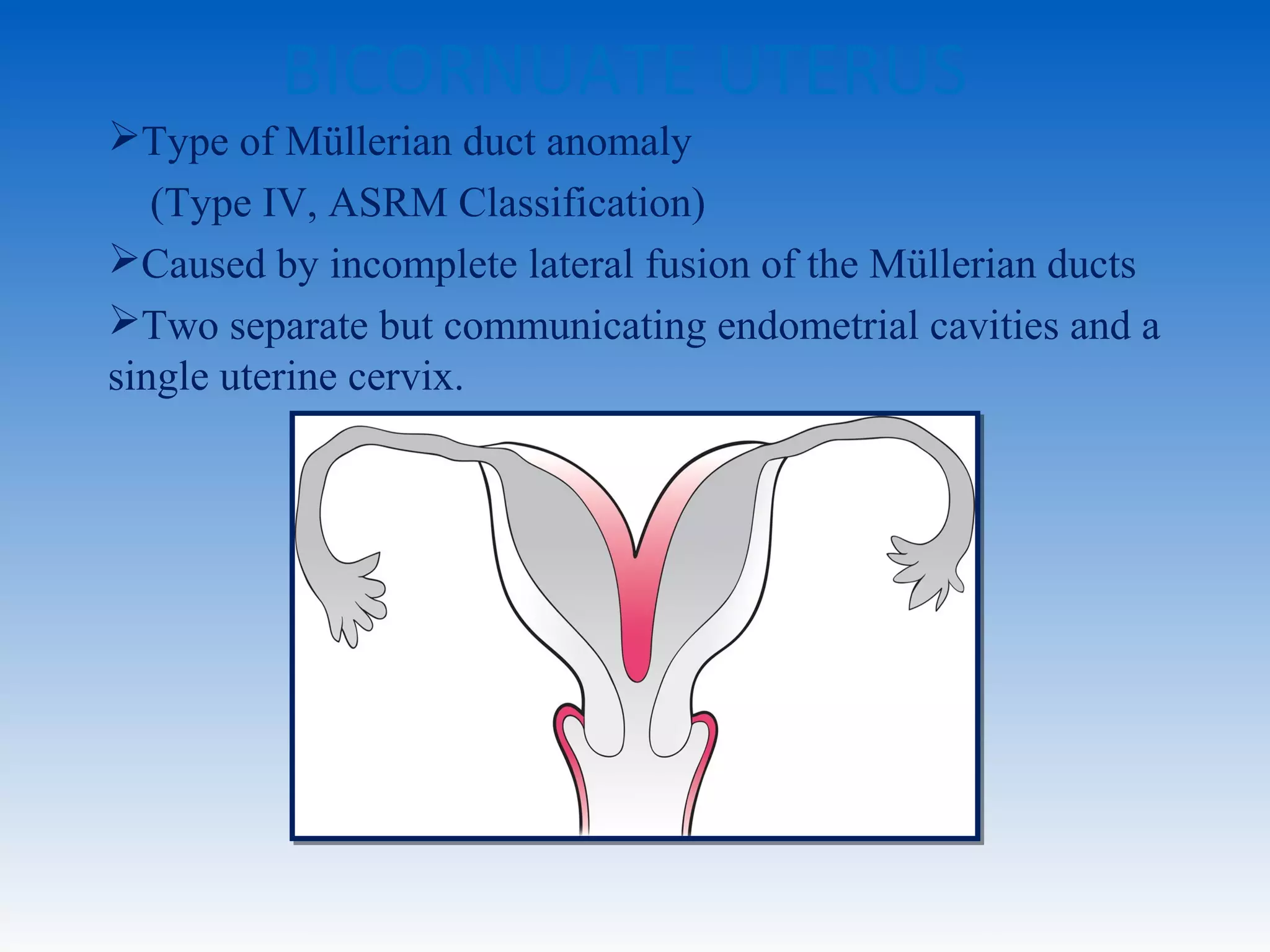 An Atypical Outcome Of Multifoetal Gestation In Bicornuate Uterus | PPT