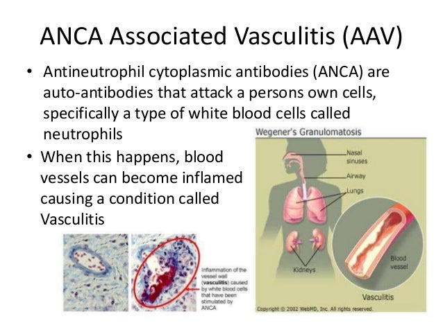 Genetically Distinct differences of ANCA-Associated Vasculitis Disord…