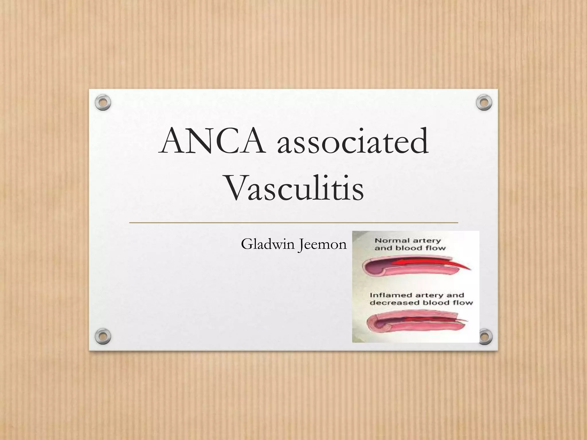 Anca associated vasculitis new | PPTX