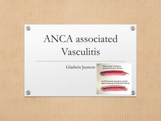 Anca associated vasculitis new | PPTX