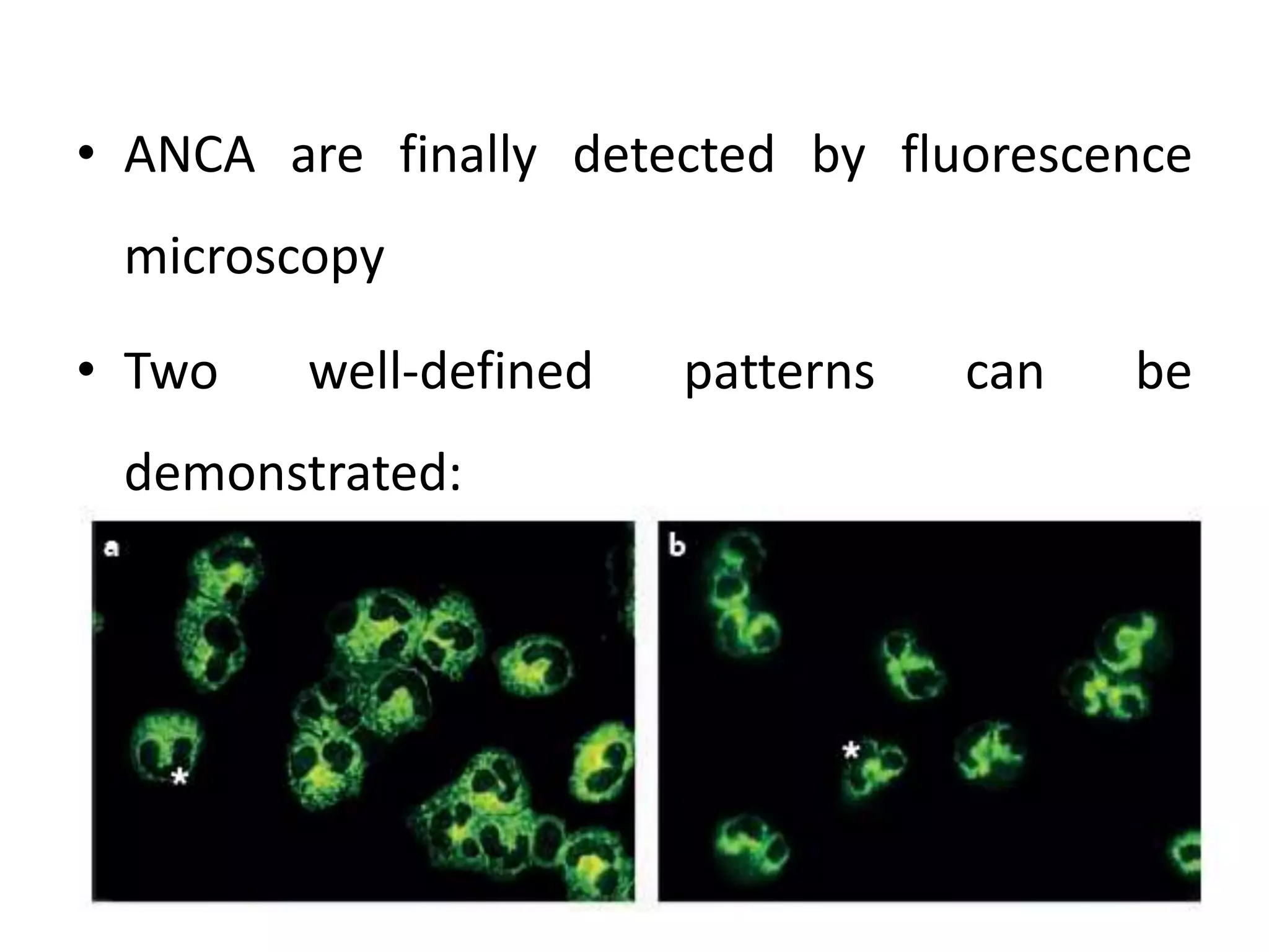 Anca testing in small vessel vasculitis | PPTX