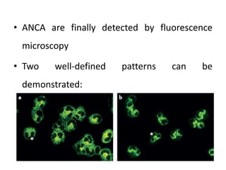 Anca testing in small vessel vasculitis | PPTX