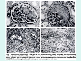Pulse vs. Daily Oral Cyclophosphamide for Induction of Remission in ...