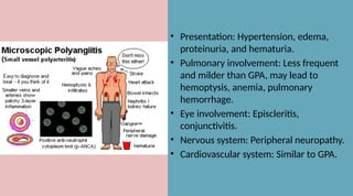 anca vasculitis in pediaric pts .pptx