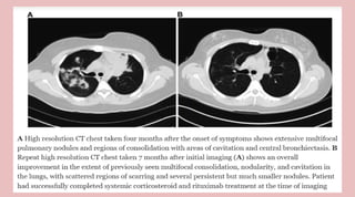 anca vasculitis in pediaric pts .pptx