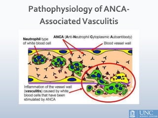 Anca vasculitis & anti gbm | PPTX