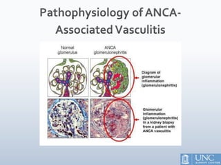 Anca vasculitis & anti gbm | PPTX