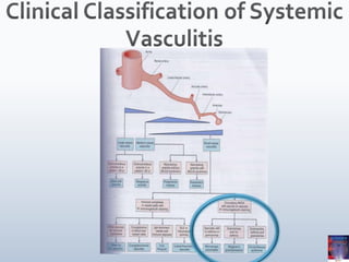 Anca vasculitis & anti gbm | PPTX