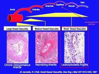 Anca vasculitis & anti gbm | PPTX