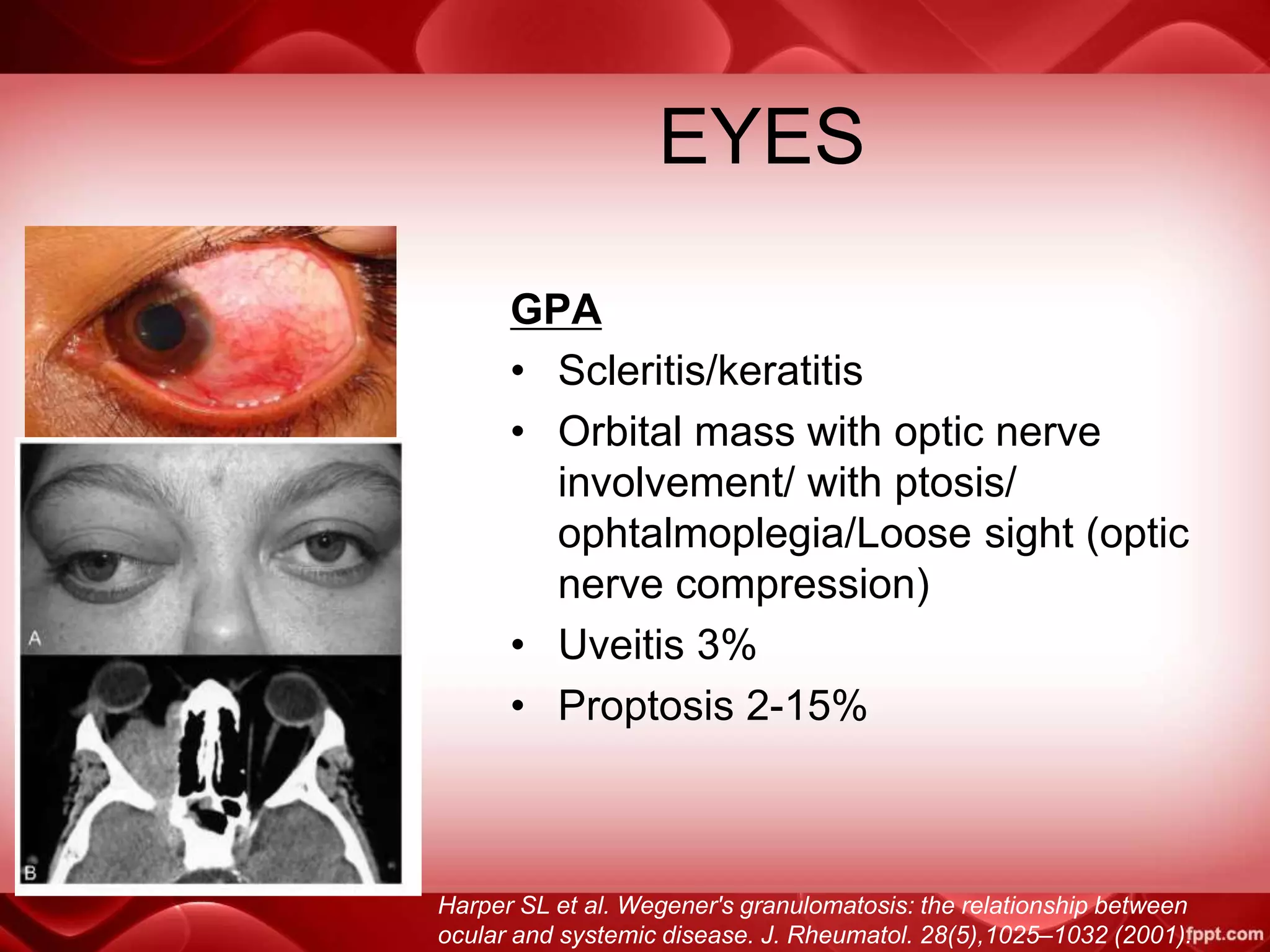 ANCA vasculitis | PPT