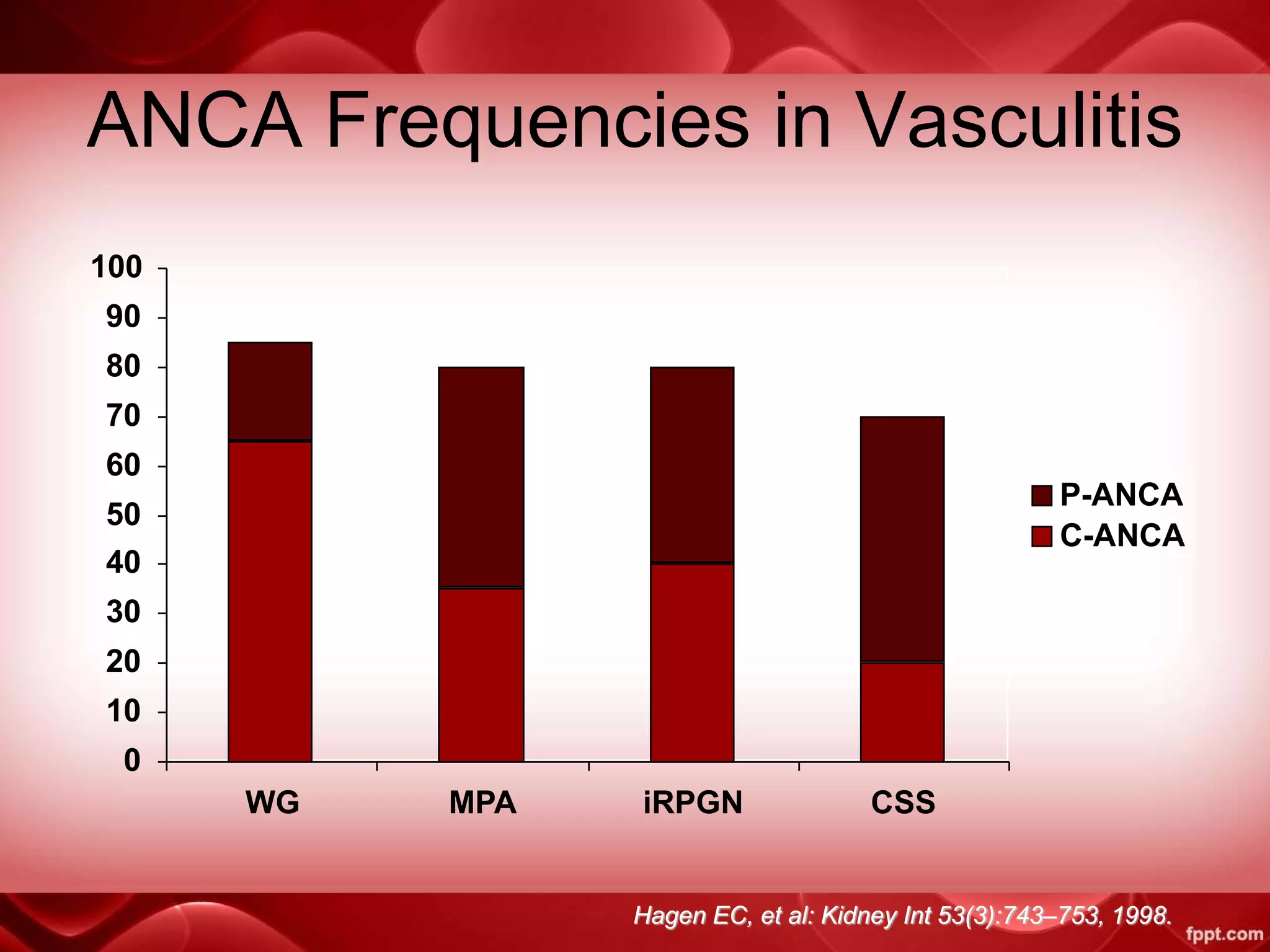 ANCA vasculitis | PPT