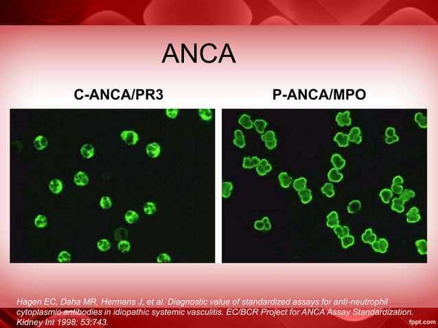 ANCA vasculitis | PPT
