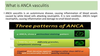 Antineutrophilic cytoplasmic Vasculitis. | PPTX