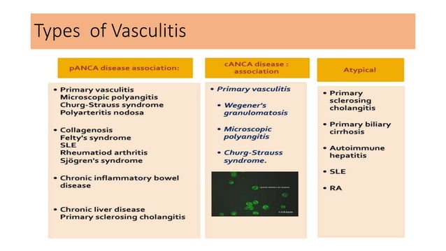 Antineutrophilic cytoplasmic Vasculitis. | PPT