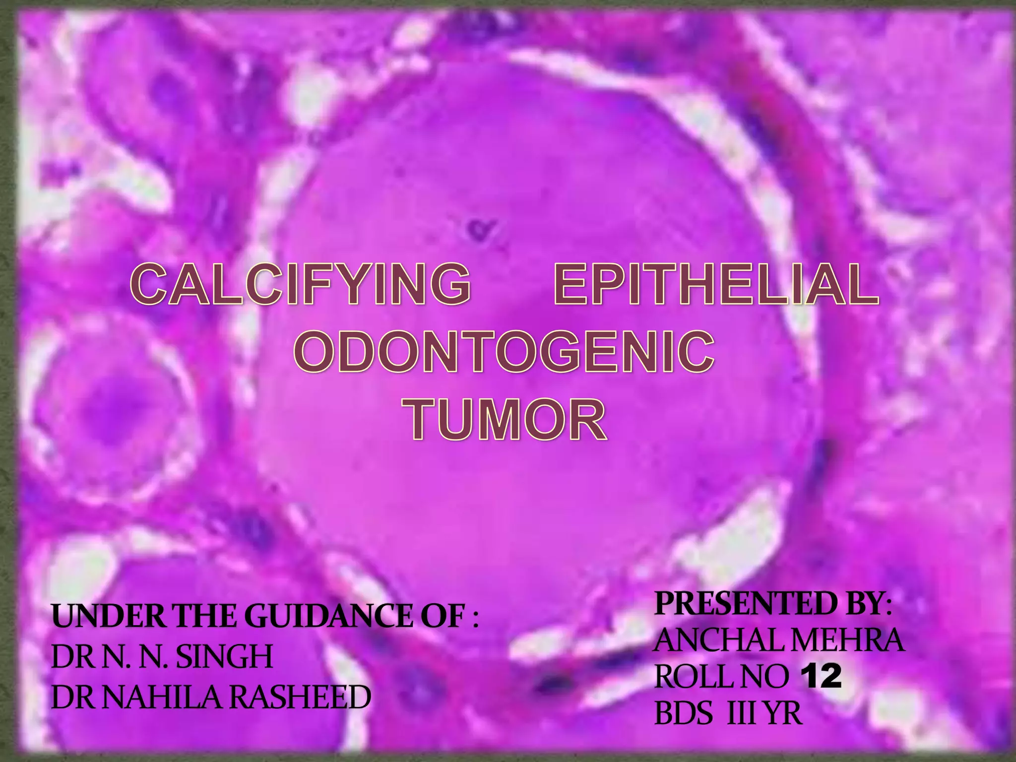 Pindborg tumor by Anchal Mehra | PPTX