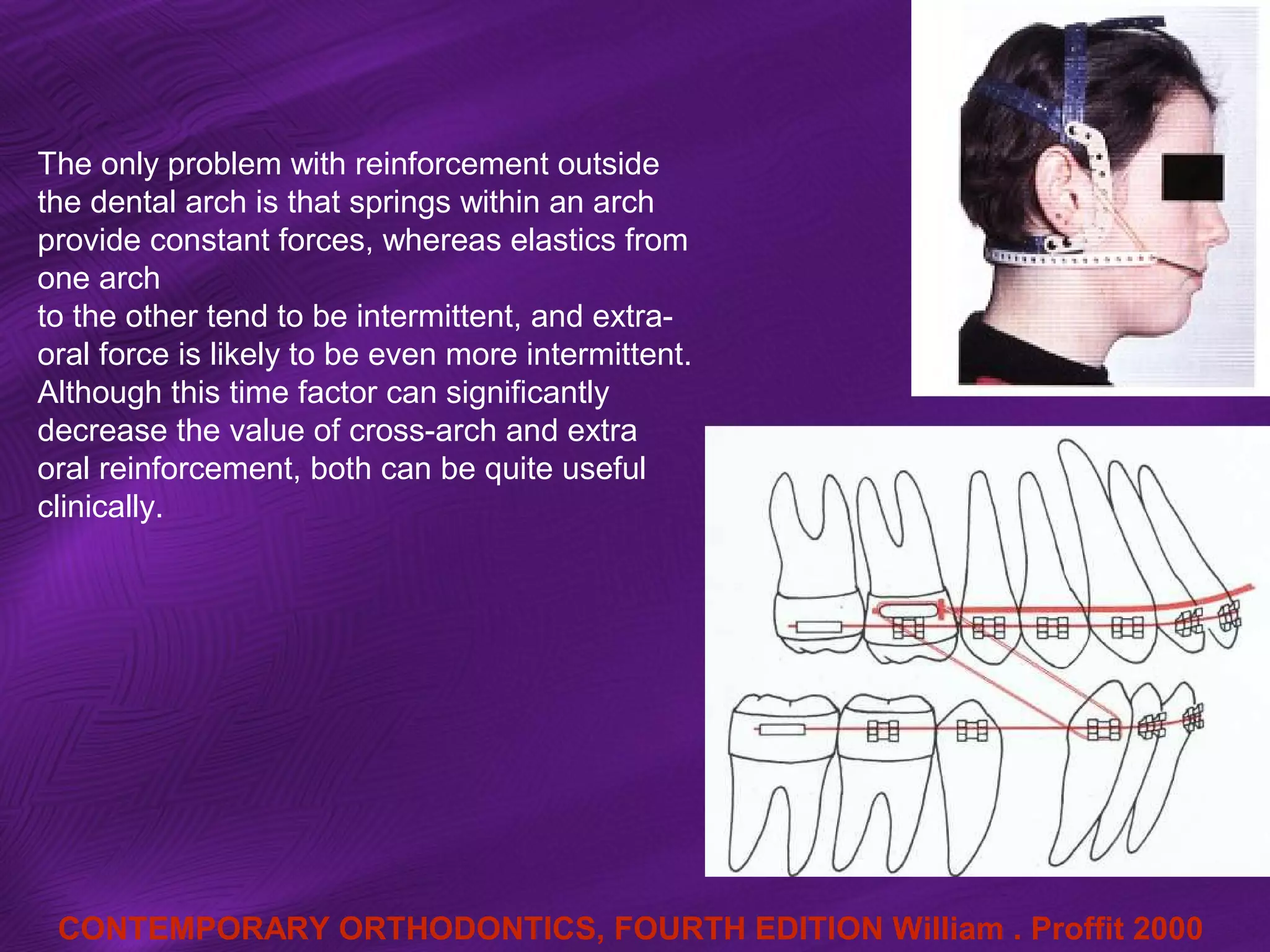 Anchorage in orthodontics | PPT