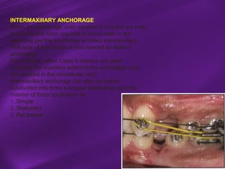 Anchorage in orthodontics | PPT