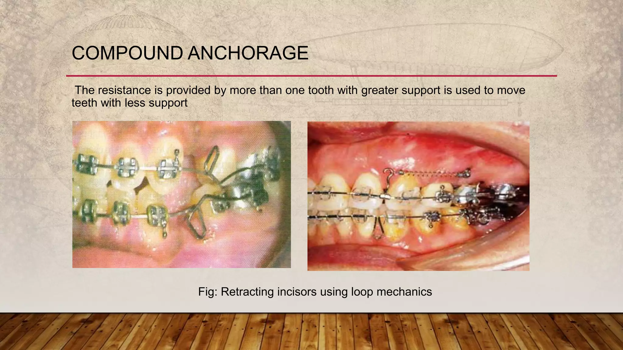 Anchorage in orthodontics | PPTX