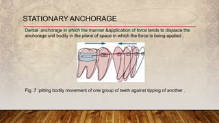 Anchorage in orthodontics | PPTX