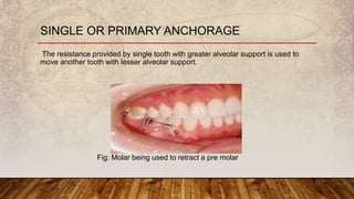 Anchorage in orthodontics | PPTX