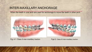 Anchorage in orthodontics | PPTX