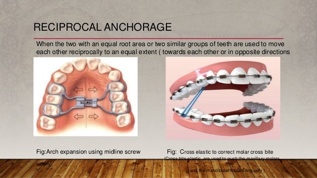 Anchorage in orthodontics