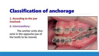Anchorage in Orthodontic | PPTX