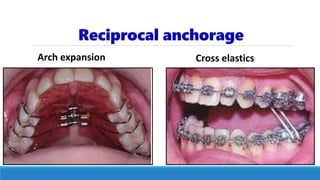 Anchorage in Orthodontic | PPTX