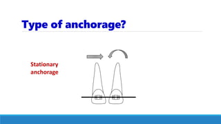 Anchorage in Orthodontic | PPTX