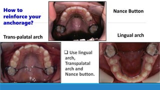 Anchorage in Orthodontic | PPTX