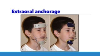 Anchorage in Orthodontic | PPTX