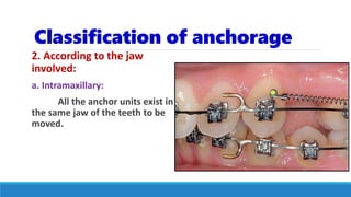Anchorage in Orthodontic | PPTX