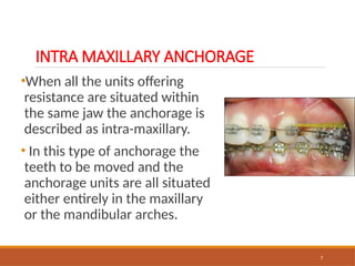 Comprehensive Overview of Orthodontic Anchorage: Types, Units, and ...