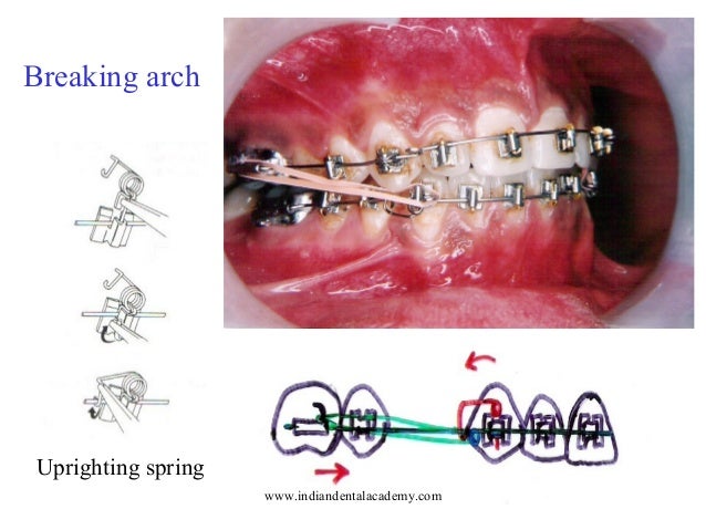 Anchorage1 (2)/certified fixed orthodontic courses by Indian dental a…