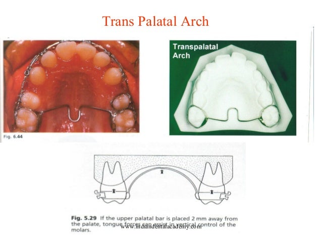Anchorage1 (2)/certified fixed orthodontic courses by Indian dental a…