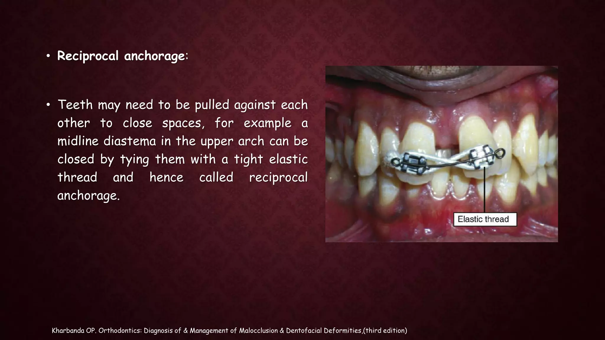 Anchorage and its control | PPTX