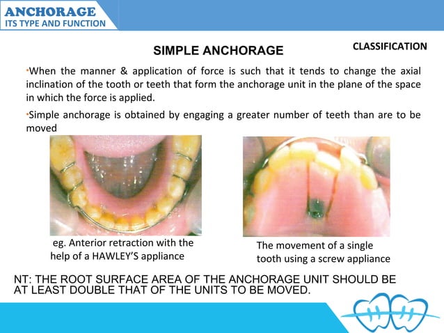 Anchorage and its type and variations | PPT