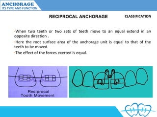Anchorage and its type and variations | PPT