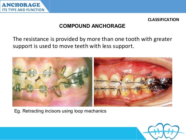 Anchorage and its type and variations
