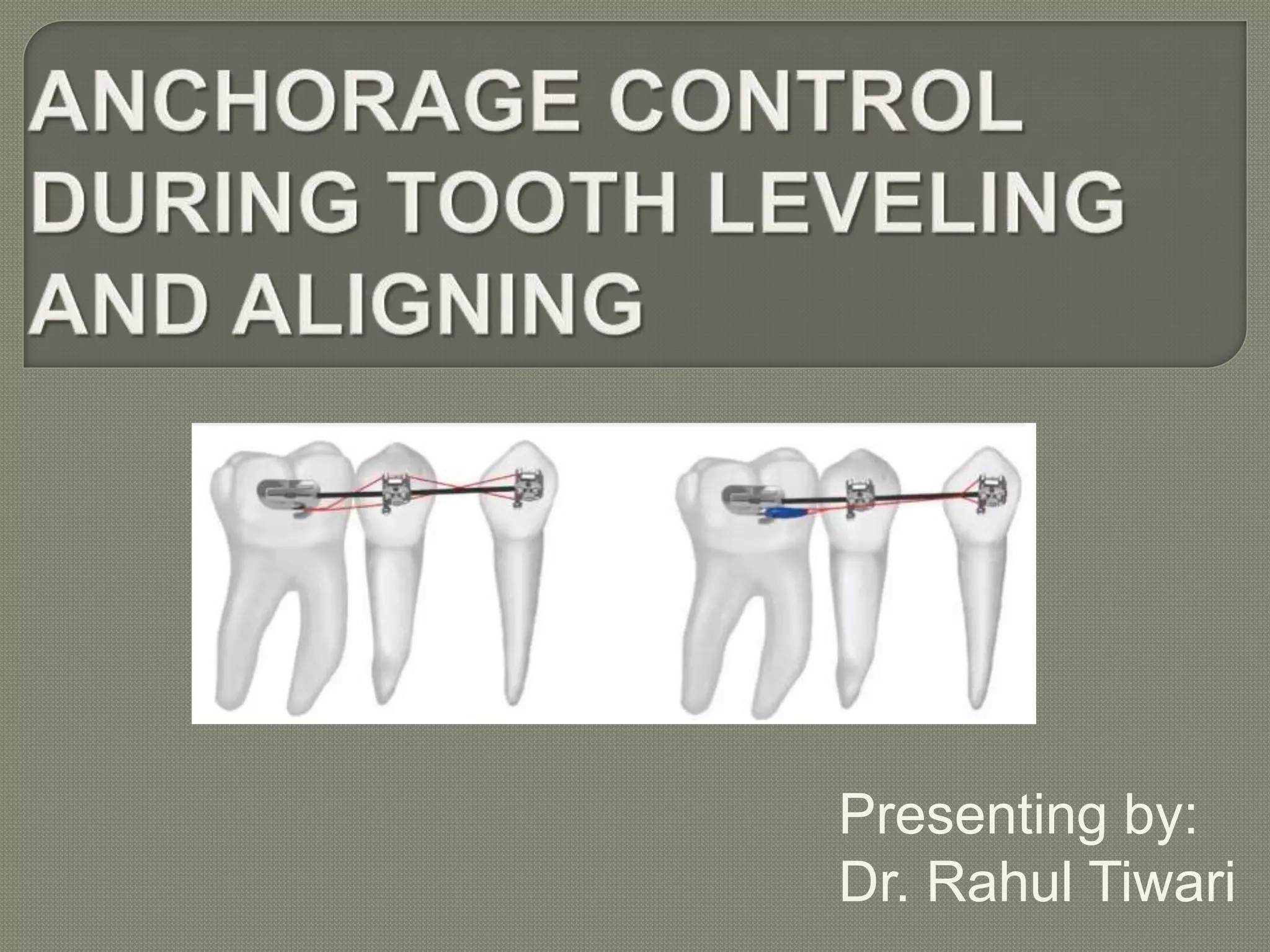 Anchorage control during tooth leveling and aligning | PPTX