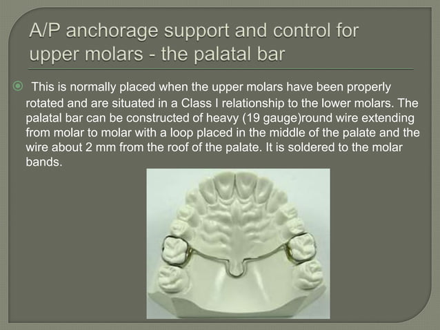 Anchorage control during tooth leveling and aligning | PPTX | Dental ...